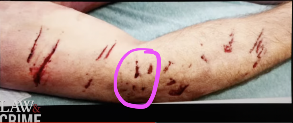 Canton Coverup Part 491: Hank Brennan Is Afraid To Let Karen Read Jury Hear From Dog Bite Expert ...